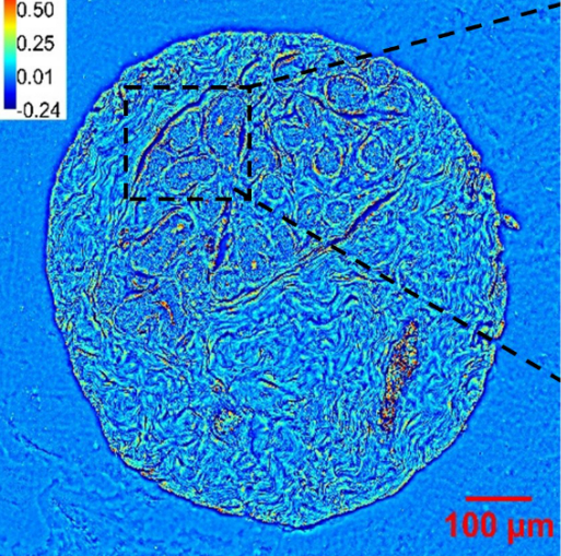 New optical method promises more accurate diagnosis for cancer patients ...